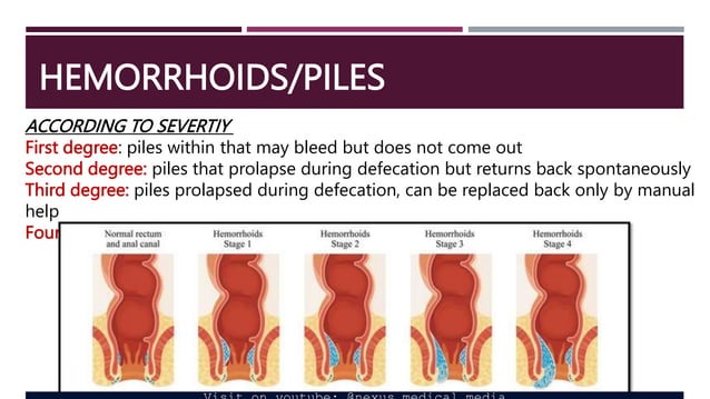 HEMORRHOIDS- anatomy, pathophysiology, clinical features, diagnosis and ...