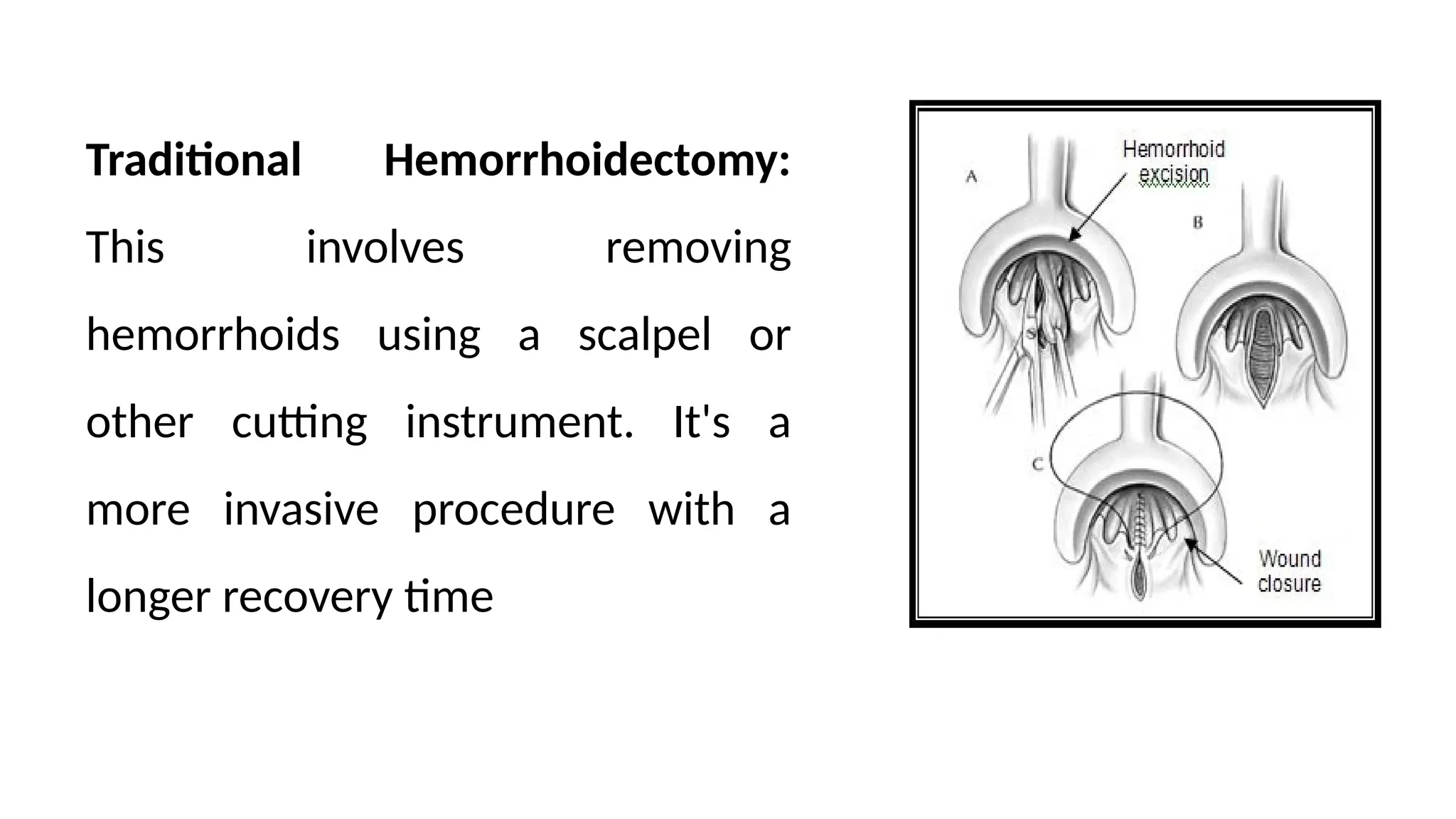 Hemorrhoids Pptx For Bsc Nursing Ppt Ppt