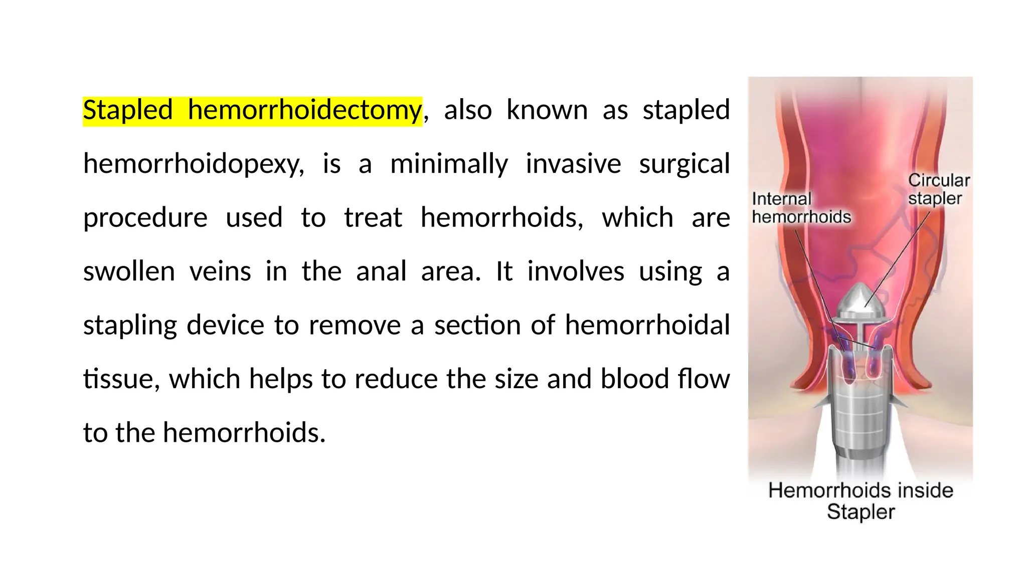 Hemorrhoids Pptx For Bsc Nursing Ppt Ppt