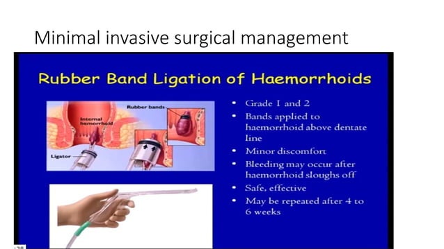 Hemorrhoids Pptx For Bsc Nursing Ppt Ppt