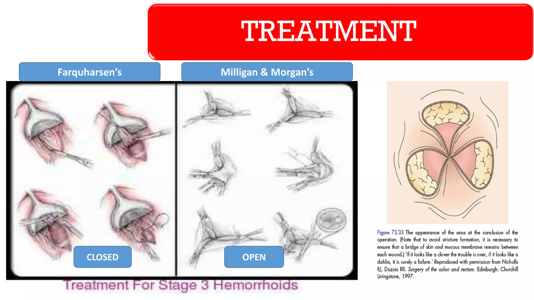 hemorrhoids-lowergihemorrhage-170326044209 (1).pdf
