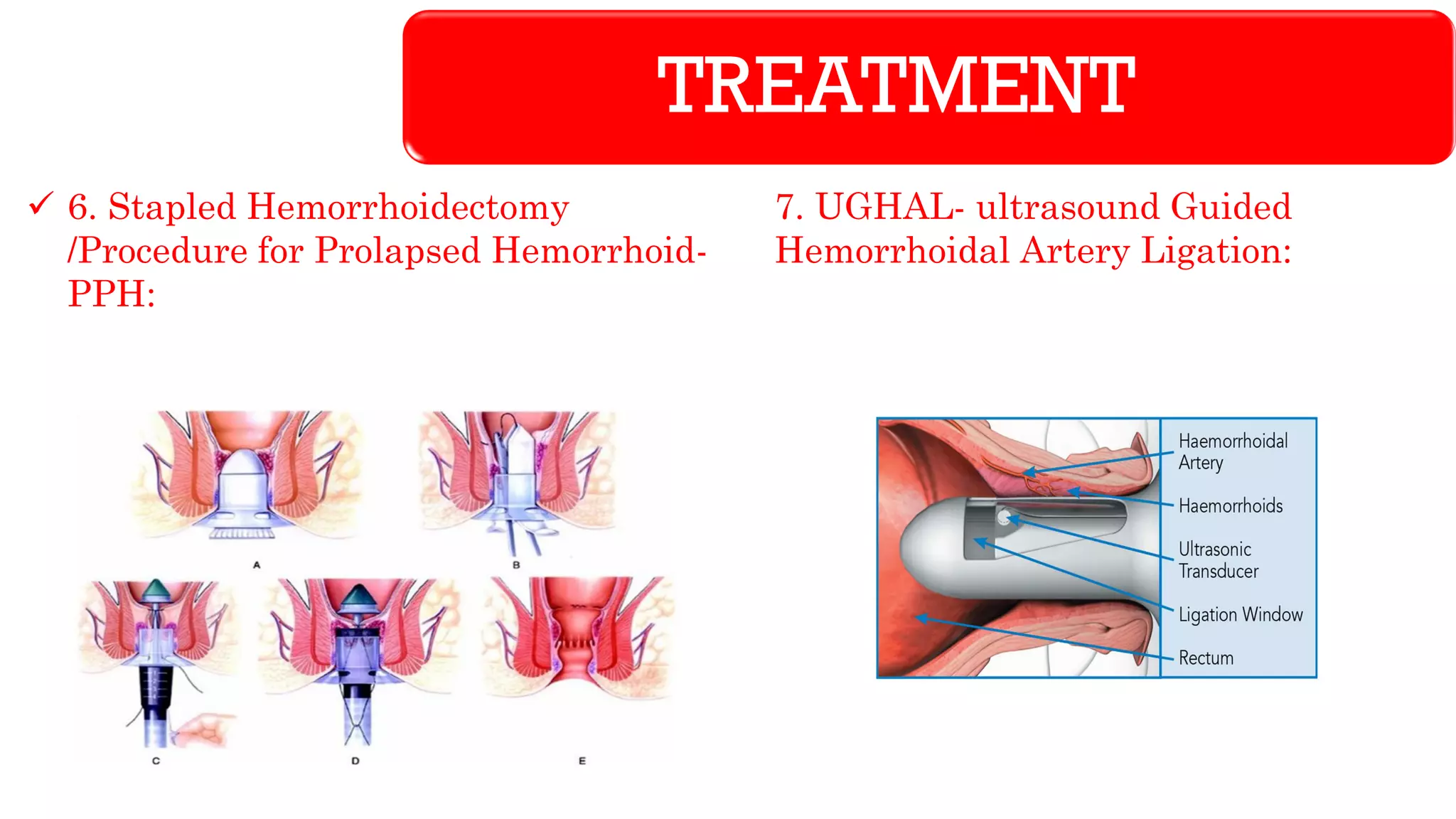 hemorrhoids-lowergihemorrhage-170326044209 (1).pdf