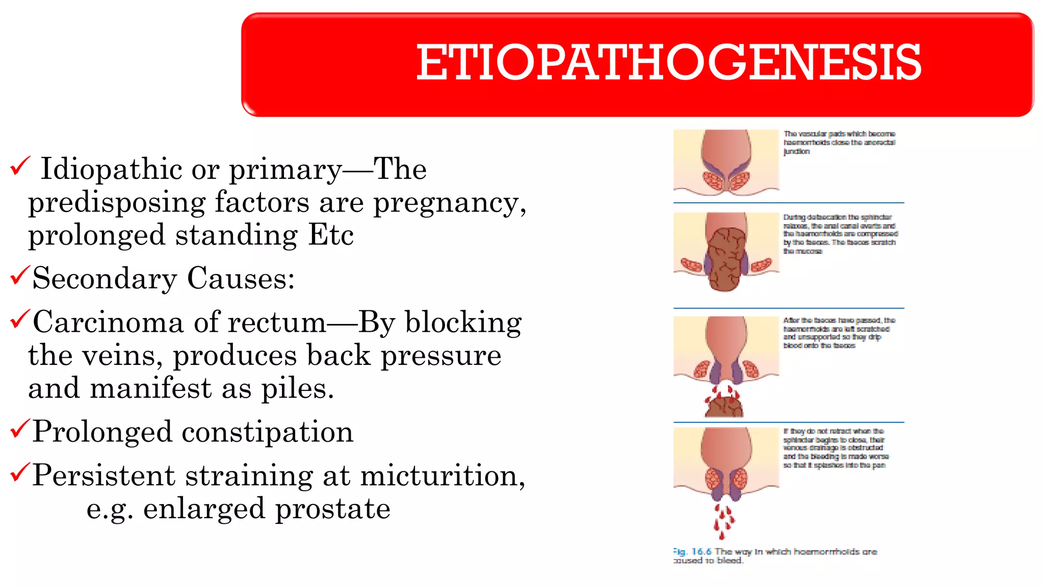 hemorrhoids-lowergihemorrhage-170326044209 (1).pdf