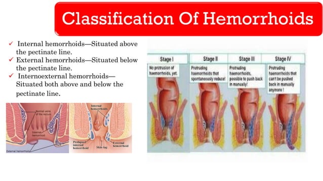hemorrhoids-lowergihemorrhage-170326044209 (1).pdf