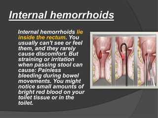 hemorrhoids (1).pptx | Blood Disorders | Diseases and Conditions