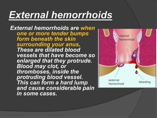 hemorrhoids (1).pptx | Blood Disorders | Diseases and Conditions