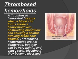hemorrhoids (1).pptx | Blood Disorders | Diseases and Conditions