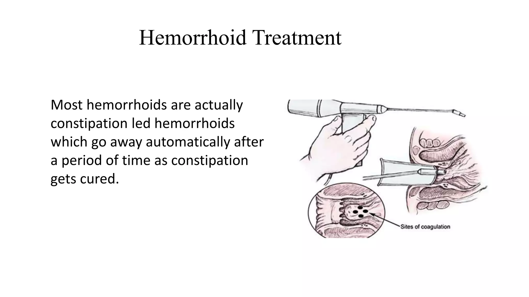 Hemorrhoid Treatment : 10 Types Of Hemorrhoid Medical Treatment | PPTX