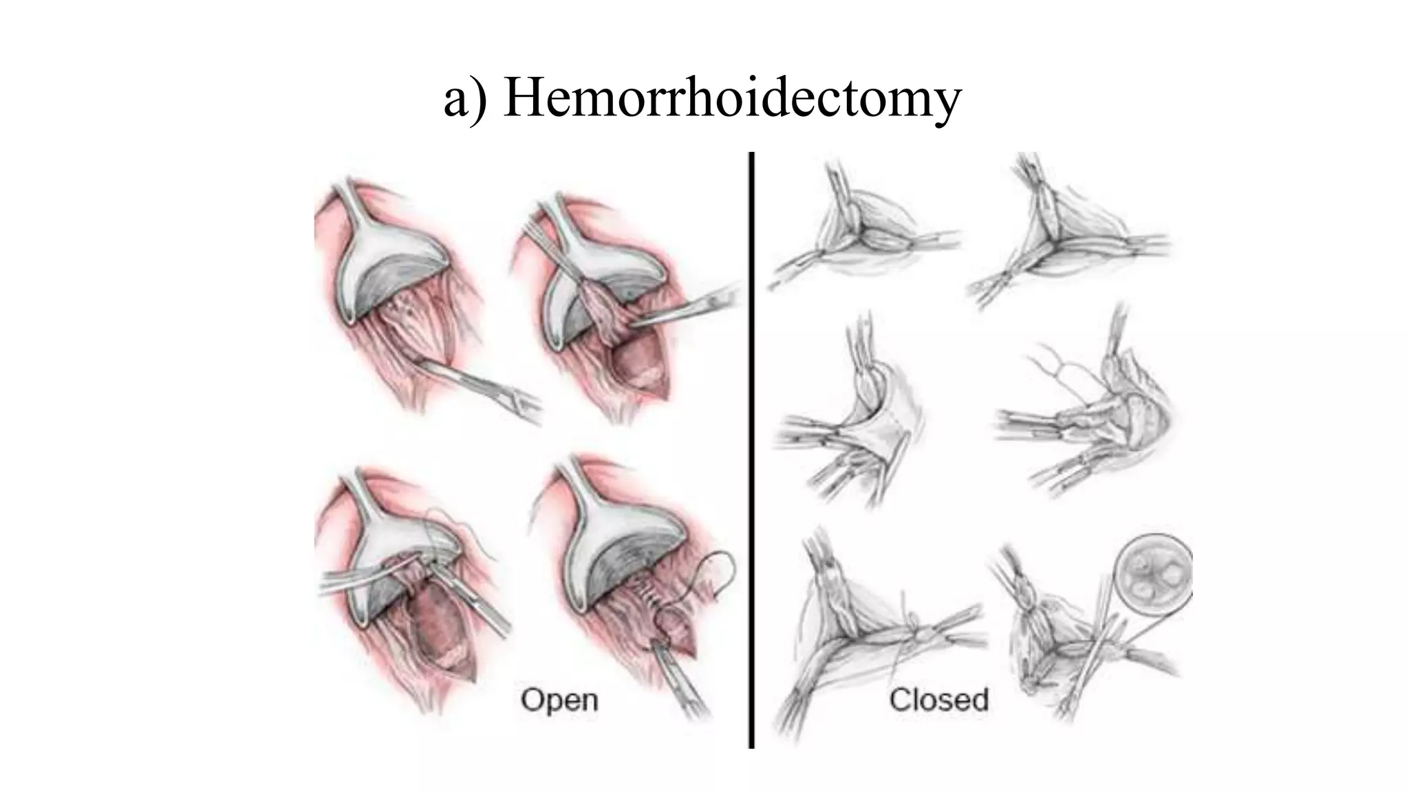 Hemorrhoid Treatment : 10 Types Of Hemorrhoid Medical Treatment | PPTX