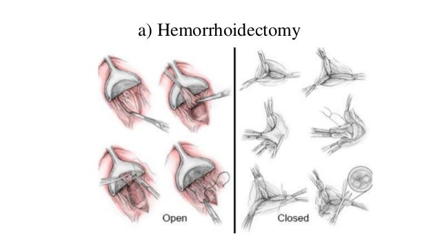 Hemorrhoid Treatment : 10 Types Of Hemorrhoid Medical Treatment
