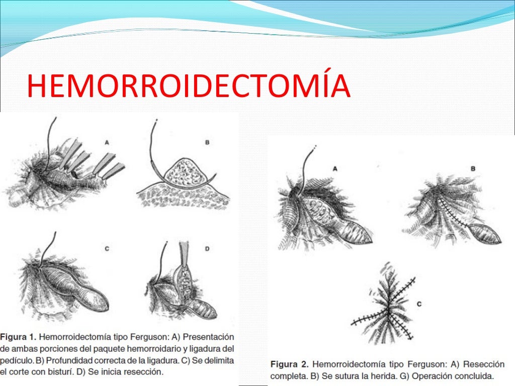 Fiz Hemorroidectomia A 6 Meses - BRAINCP