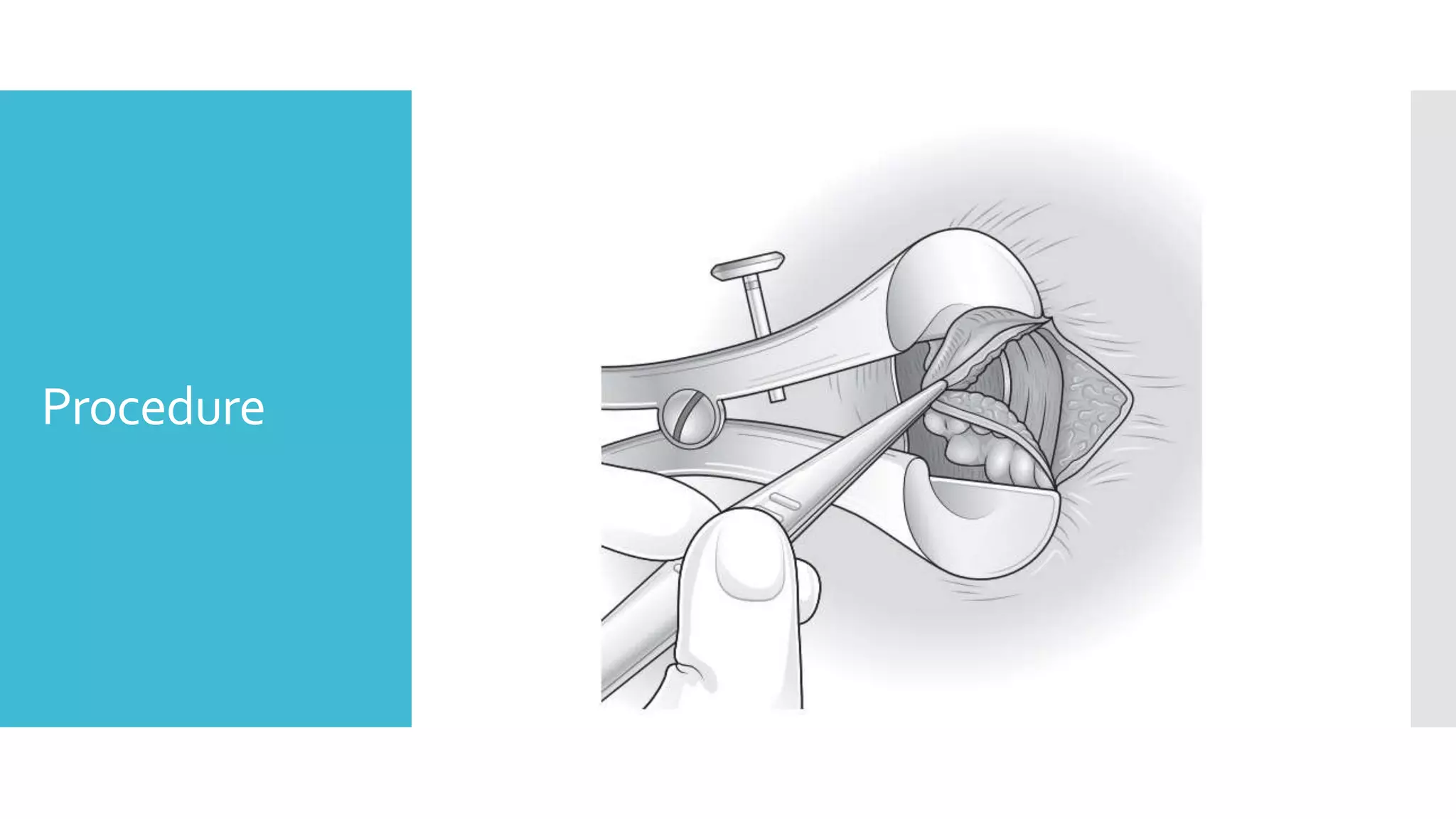 Hemorrhoidectomy.pptx