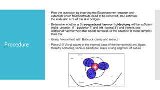 Hemorrhoidectomy.pptx