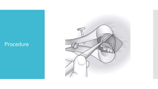 Hemorrhoidectomy.pptx