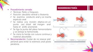 Hemorroides | PDF