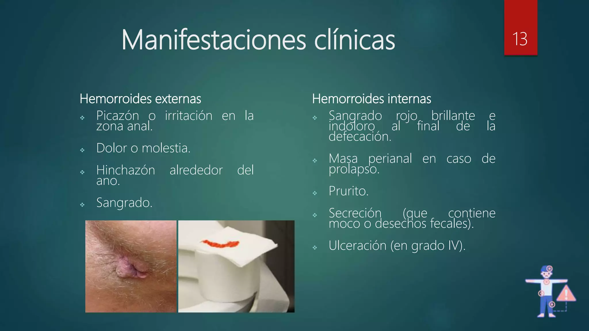 HEMORROIDES | PPTX