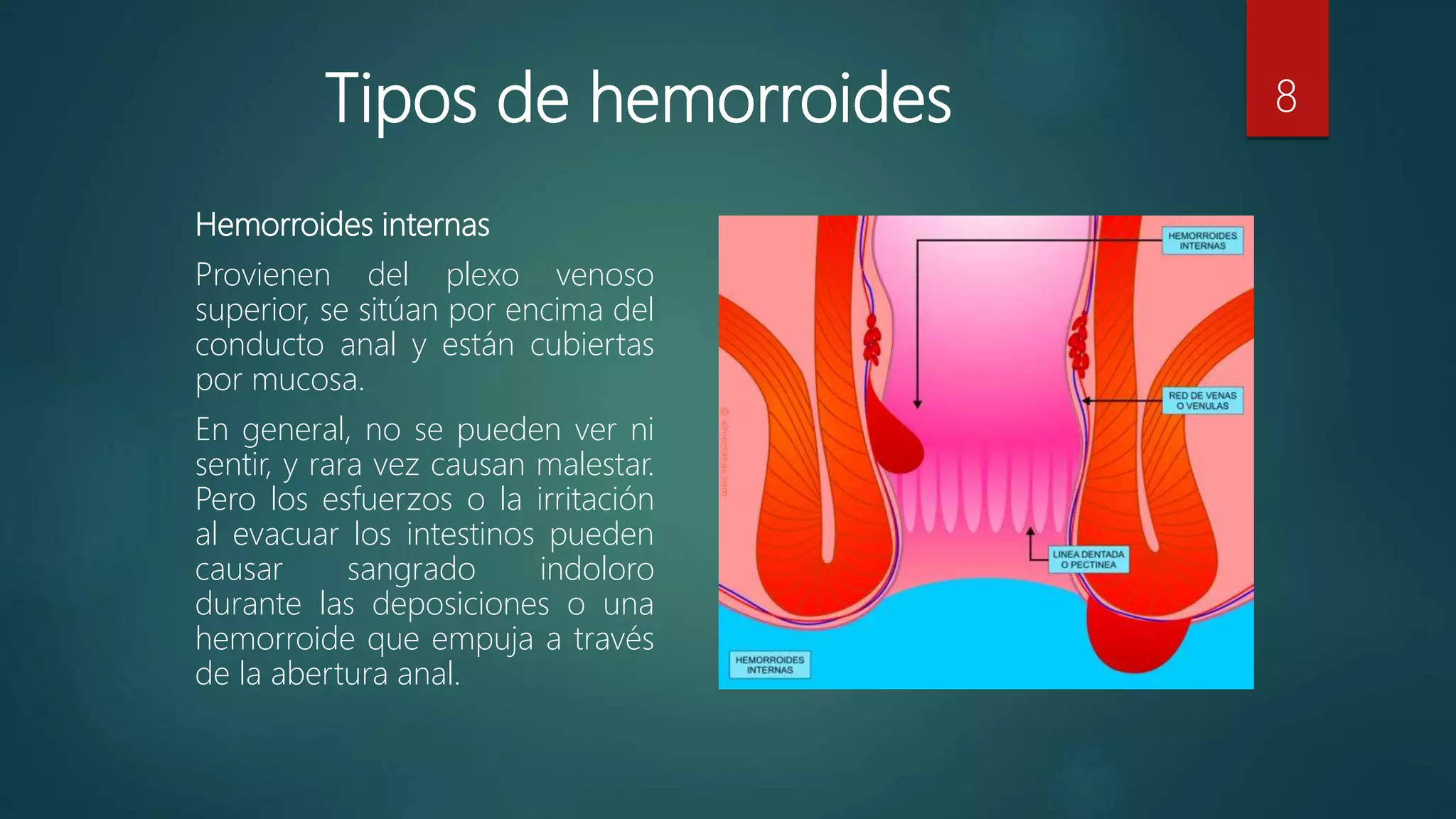 HEMORROIDES | PPTX