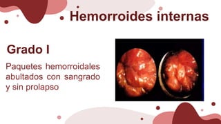 Hemorroides.pptx
