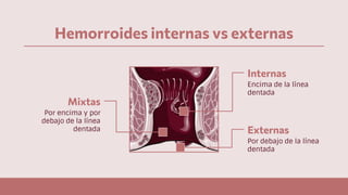 Hemorroides Clase Residencia- R1MI Marissa-2.pptx