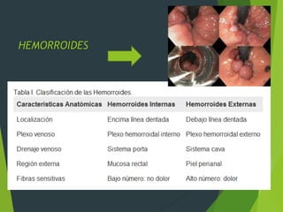 Hemorroides htca 2016 | PPTX