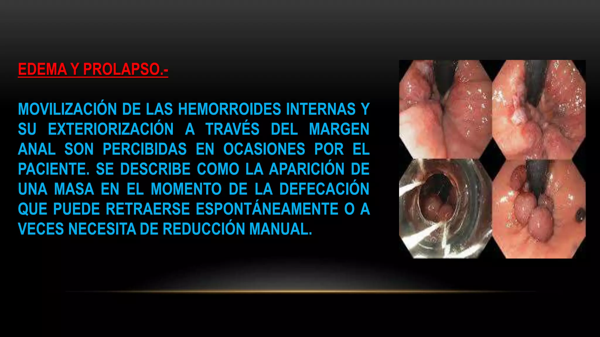 Hemorroides Internas Sintomas