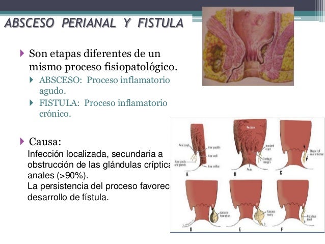 Hemorroides y otras patologias orificiales
