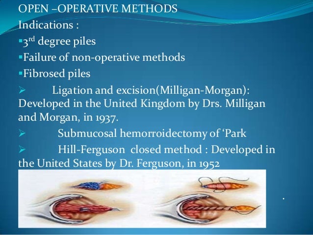 Hemorrhoids:Its current management