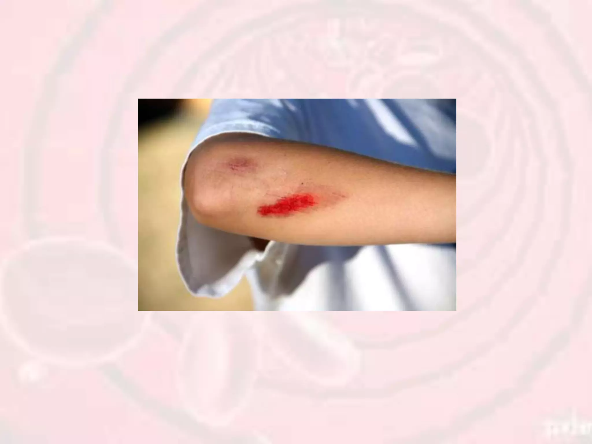 HEMOSTASIS /stages of hemostasis / Formation of platelet plug ...