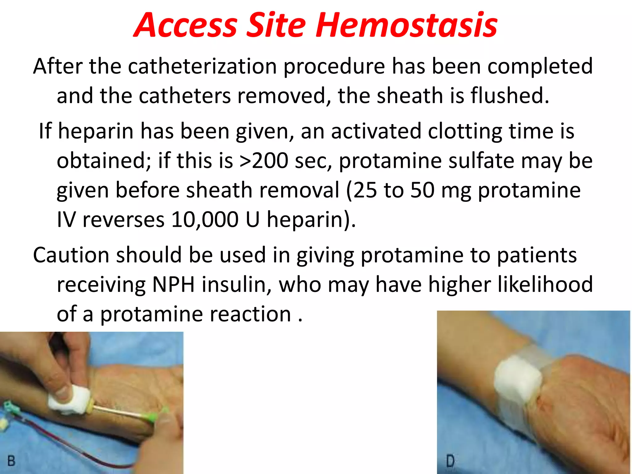 Hemostasis for arterial acecss site | PPSX