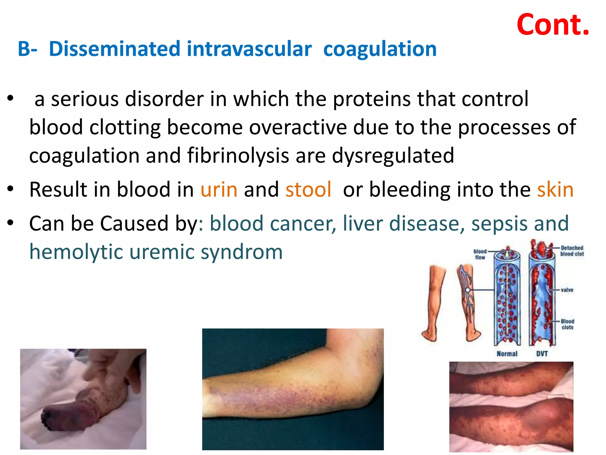 Hemostatic abnormalities | PPTX