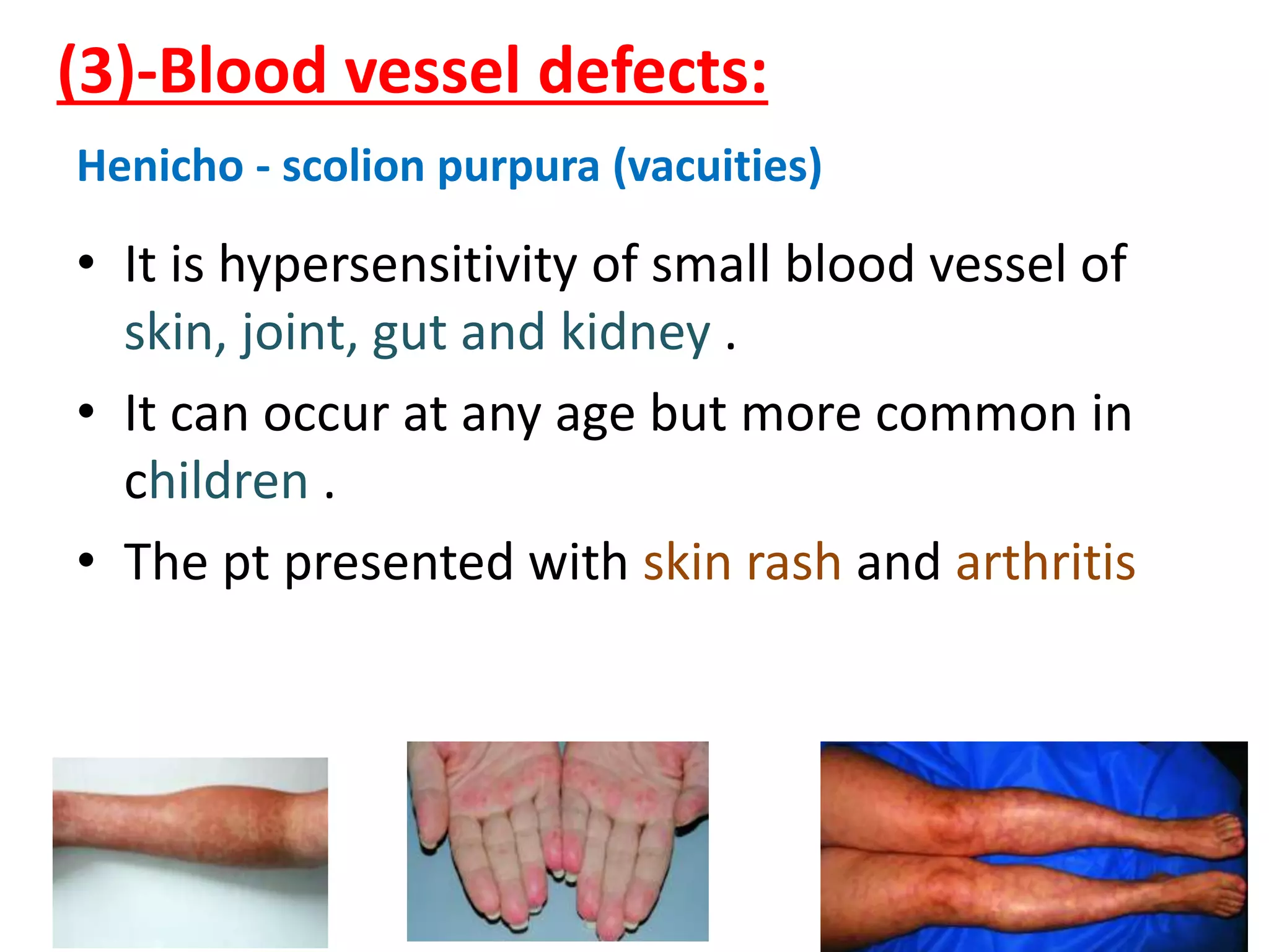 Hemostatic abnormalities | PPTX