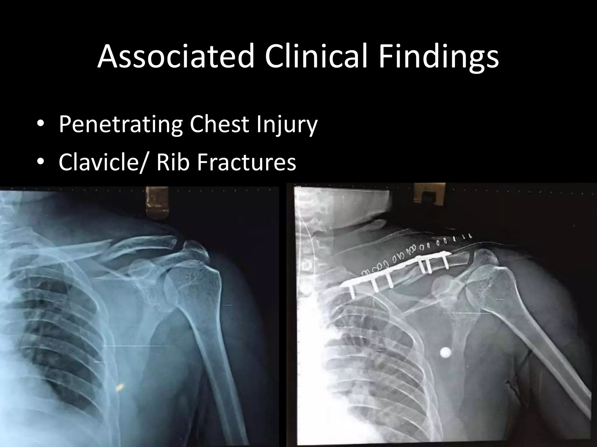 Traumatic Hemothorax and Intercostal Drainage | PPTX