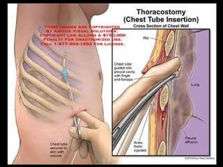 Hemothorax Chest Tube