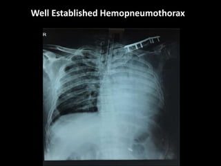 Hemothorax Xray