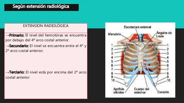 Hemotorax y neumotorax