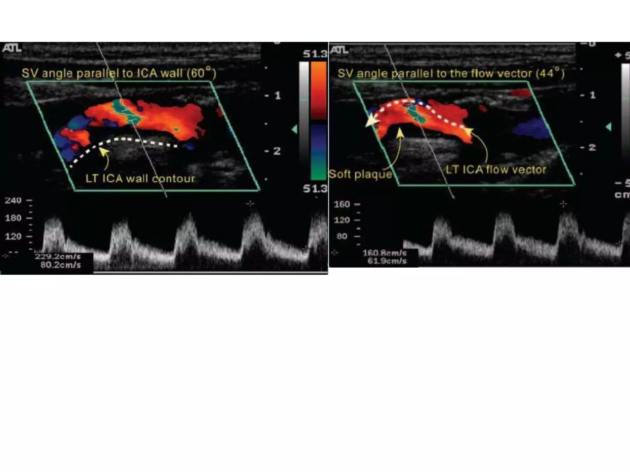 carotid doppler u/s Radiology | PPTX