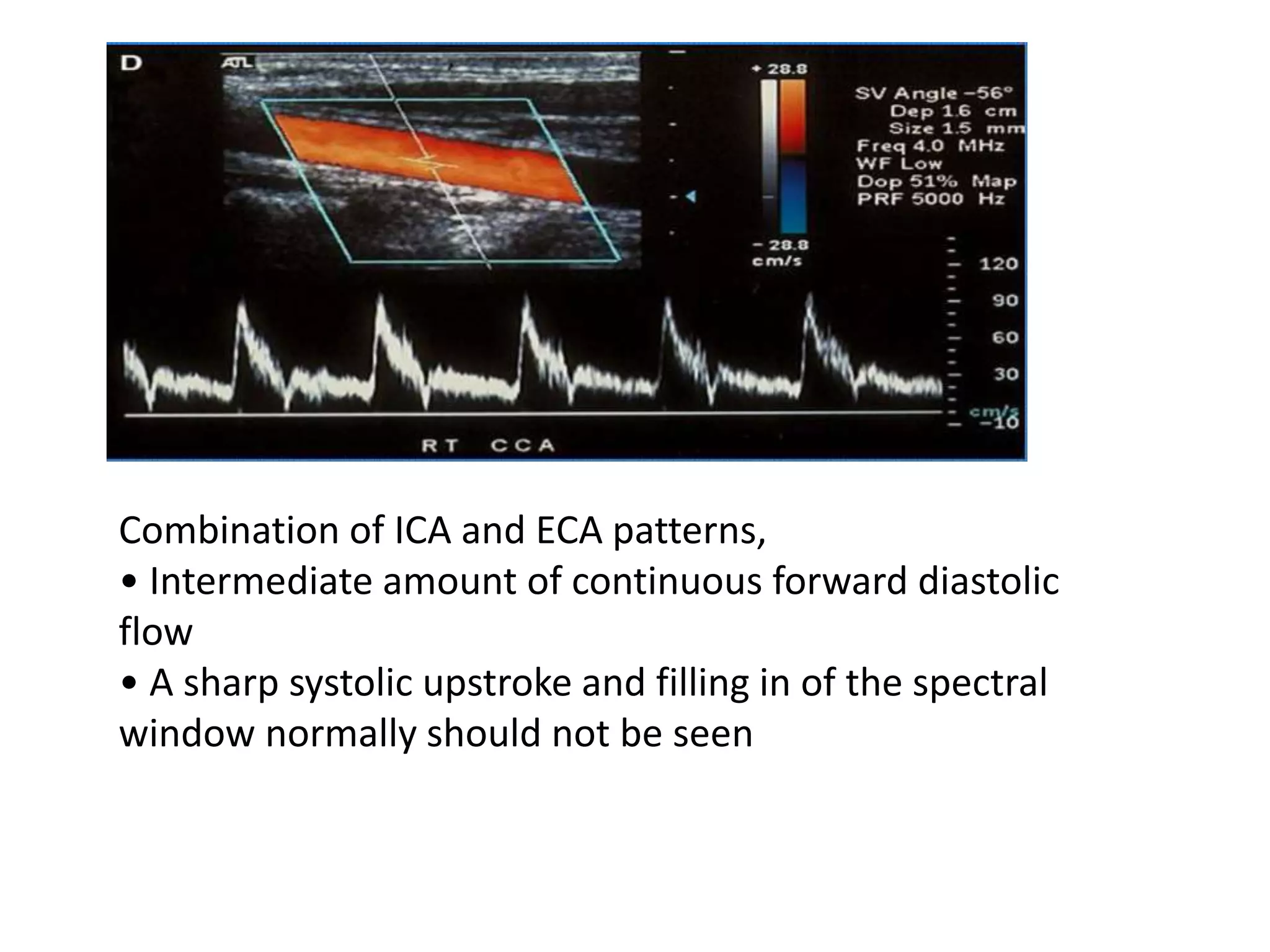 carotid doppler u/s Radiology | PPTX