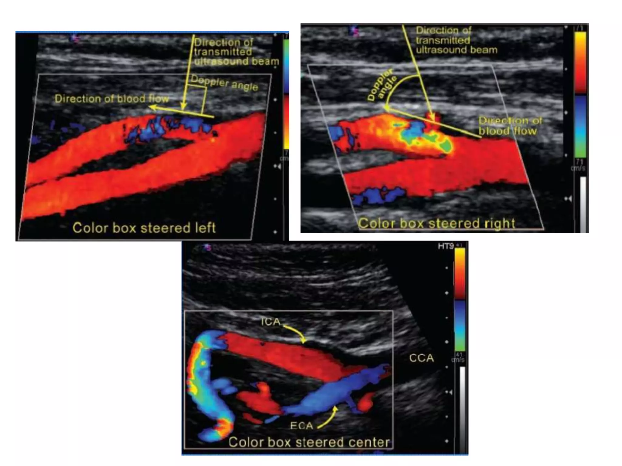 carotid doppler u/s Radiology | PPTX