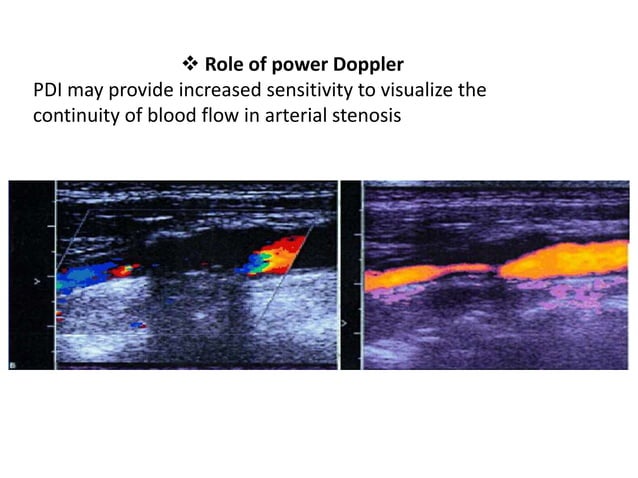 carotid doppler u/s Radiology | PPTX