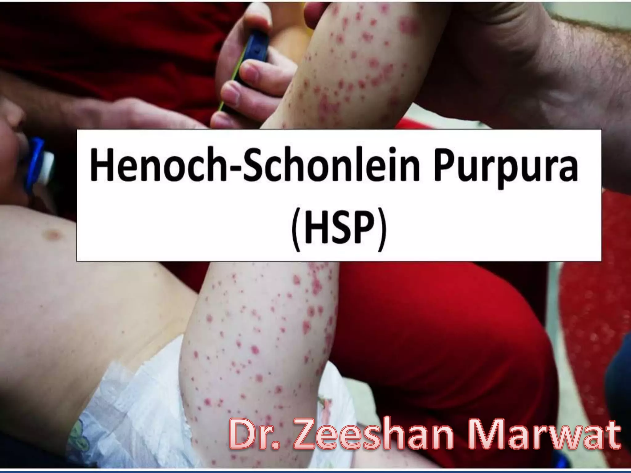 Henoch schenolin purpura.pptx