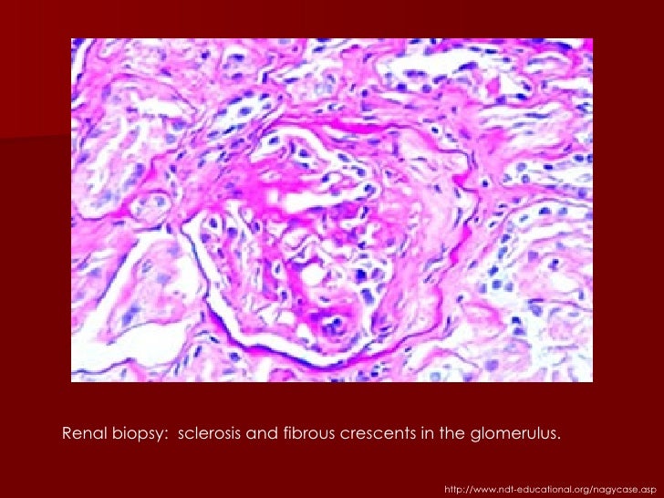 Henoch Schonlein Purpura