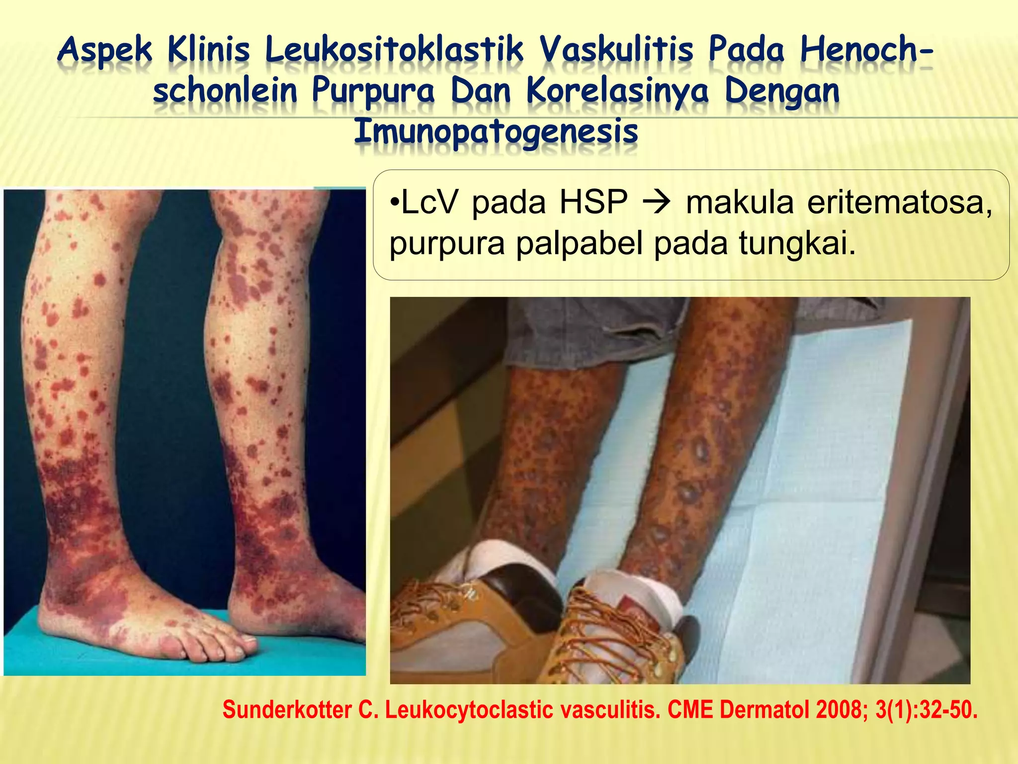 Immunopathogenesis Leukocytoclastic Vasculitis in Henoch Schonlein Purpura | PPT