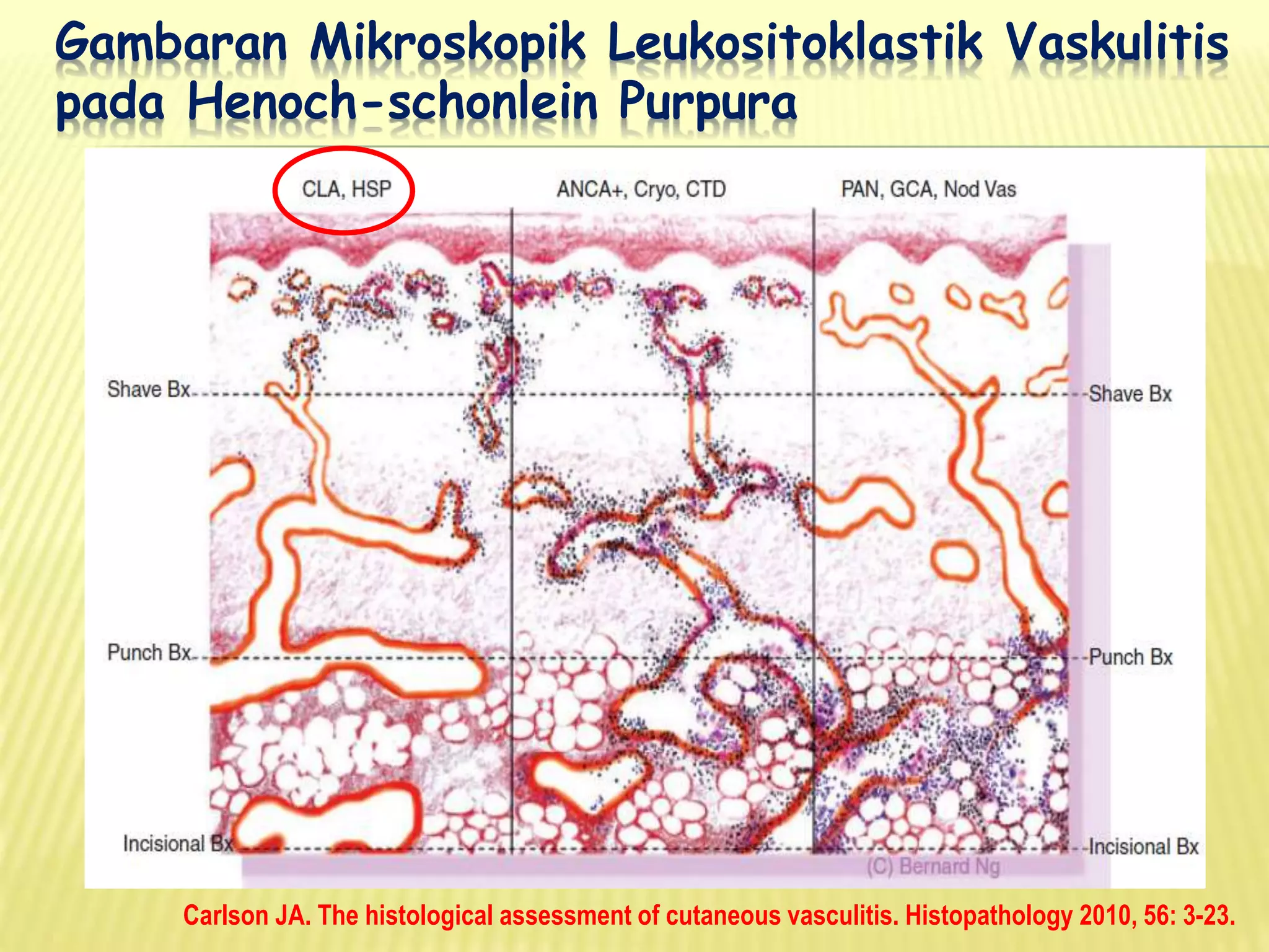 Immunopathogenesis Leukocytoclastic Vasculitis in Henoch Schonlein ...