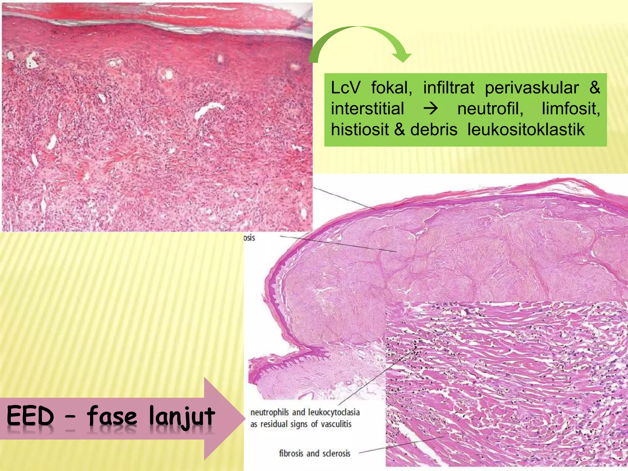 Immunopathogenesis Leukocytoclastic Vasculitis in Henoch Schonlein ...