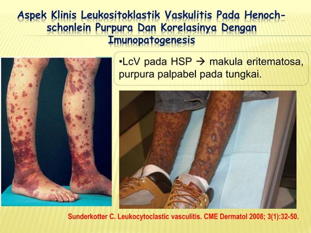 Immunopathogenesis Leukocytoclastic Vasculitis in Henoch Schonlein ...
