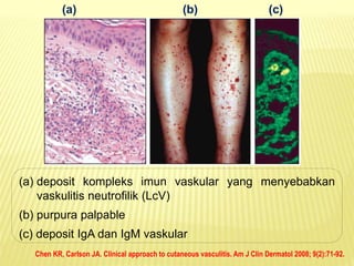 Immunopathogenesis Leukocytoclastic Vasculitis in Henoch Schonlein ...