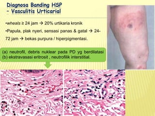 Immunopathogenesis Leukocytoclastic Vasculitis in Henoch Schonlein Purpura | PPT