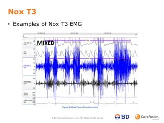 Henry Schein dental nox t3 presentation current | PPTX