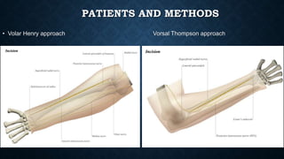 Henry versus thompson approach for fixation of proximal third radial ...