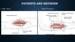Henry versus thompson approach for fixation of proximal third radial ...